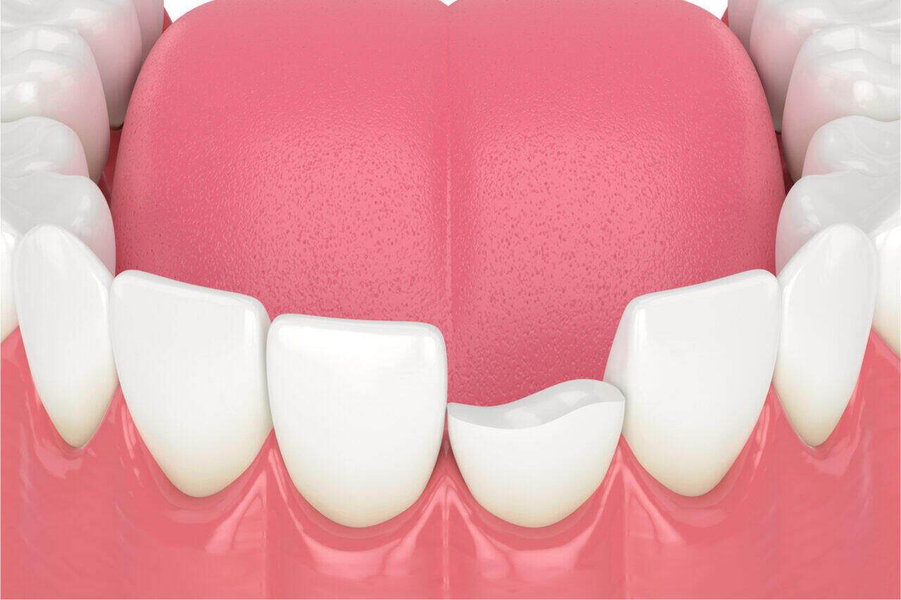 Oh No! I Have A Broken Front Tooth. What To Do About It?